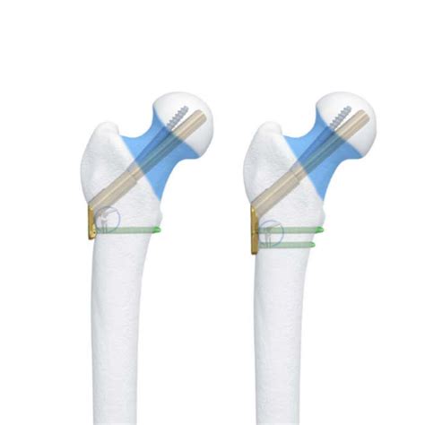 Femoral Neck System Fns Lyntop Medical