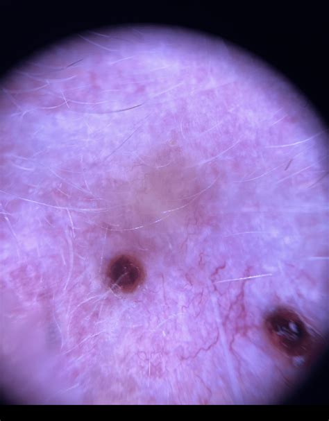 How Would You Manage These Lesions On The Scalp