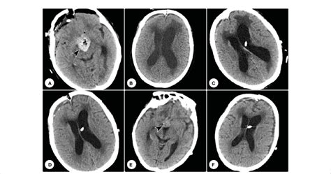 Postoperative And Follow Up Computed Tomography Examinations A Download Scientific Diagram