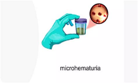 Management Of Microhematuria Aua Sufu Guidelines