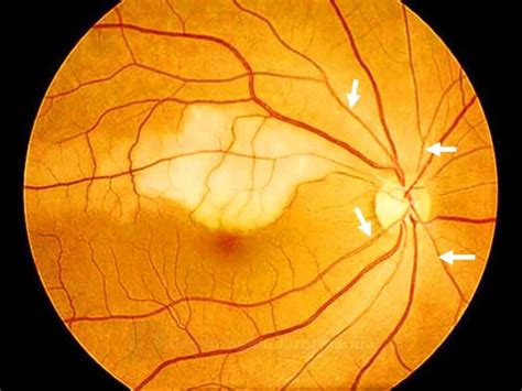 Transient Monocular Vision Loss Stroke Manual