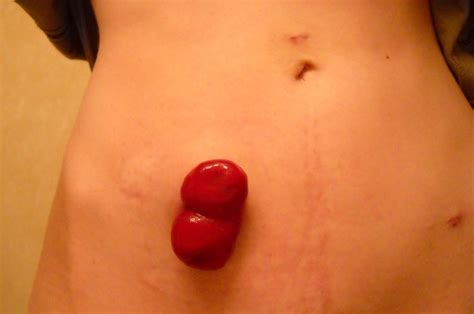 Girly Girl S Ileostomy Blog My Le Loop Stoma Changing The Bag Other Practicalities