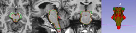Segmented Brainstem Contours Using Itk Snap Green And Freesurfer Download Scientific Diagram