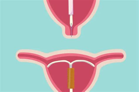 Coil Fitting Private Con‌tracep Tive Copper Coil Fitting Chelsea