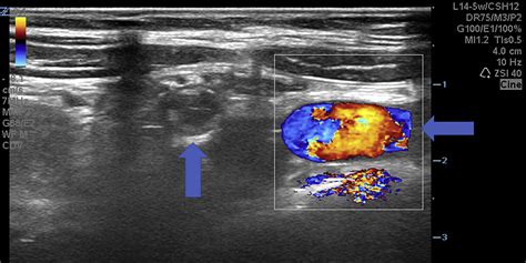 Identifying Retrocecal Appendicitis On Point Of Care Ultrasound Pocus