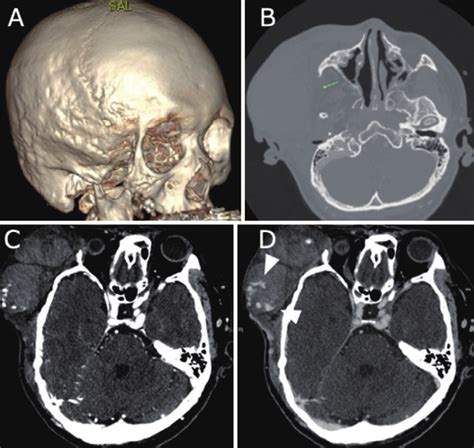 Contrast Ct Showing A Right Zygomatic Arch Defect B Atrophy Of The