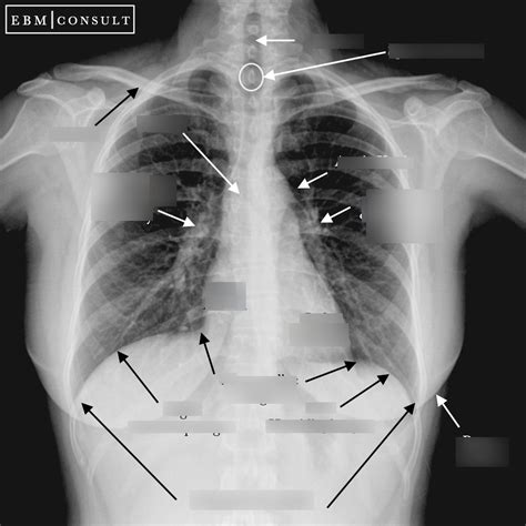 chest x ray diagram quizlet