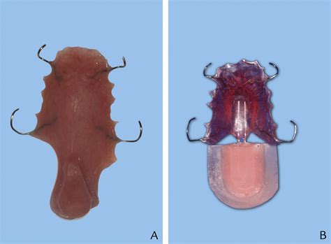 What Is A Palatal Lift At Melissa Knop Blog