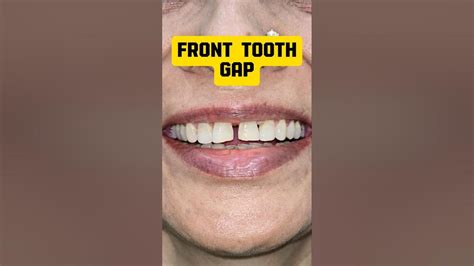 How To Fix Front Teeth Gap Teeth Teethgap Dentalytshorts Youtube
