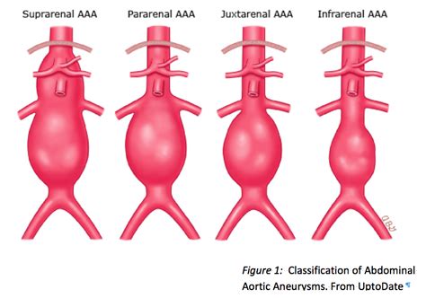 Emergency Medicine Educationabdominal Aortic Aneurysm