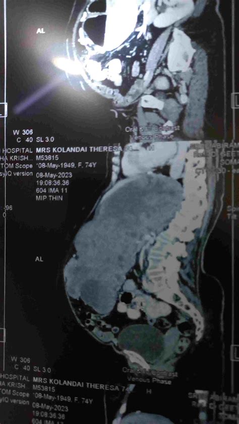 Gist Stomach Gateway Clinics Coimbatore Gateway Clinics Coimbatore