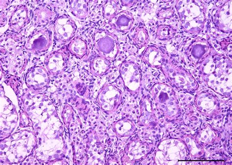 Cryptorchid Testicle With Moderate To Marked Tubular Degeneration With