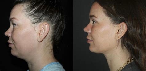 Submental Liposuction Before And After Gallery Cc Plastic Surgery