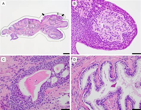 Urethral Polyp