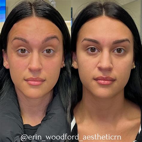 Neuromodulators Rēvive Medical Aesthetics