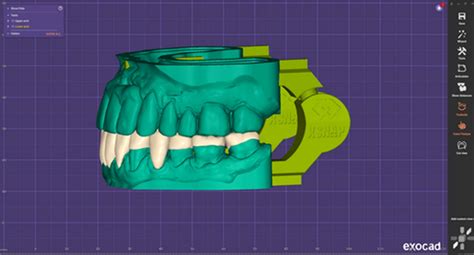 exocad xSNAP für Model Creator Denseo