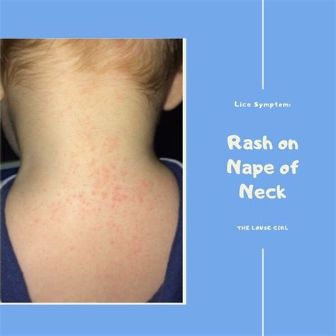 Head Lice Rash On Neck Pictures At Eliza Case Blog