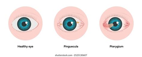 Pinguecula And Pterygium Pronunciation