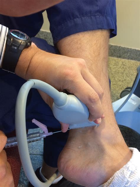 Posterior Tibial Nerve Block Zuckerem Northwell