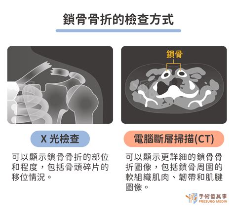 鎖骨骨折癒合時間要多久？治療選擇、禁忌動作、注意事項