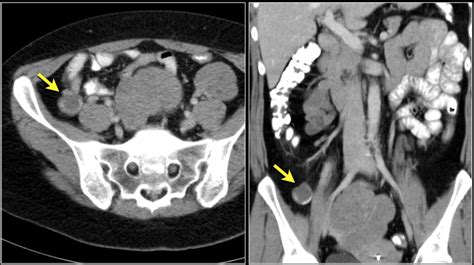 The Radiology Assistant Small Bowel Tumors