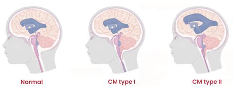 Chiari Malformation Symptoms Diagnosis And Treatment