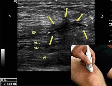 Ultrasound Imaging Of Quadriceps Tendon In A Recreational Golfer