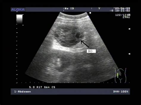 Ovarian Torsion Caused By Hyperreactio Luteinalis In The Third Trimester Of Pregnancy A Case