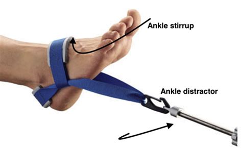 This Image Details The Setup For An Ankle Arthroscopy The Ankle Is Download Scientific Diagram