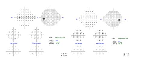 Octcases Neuro Ophtho Case 27