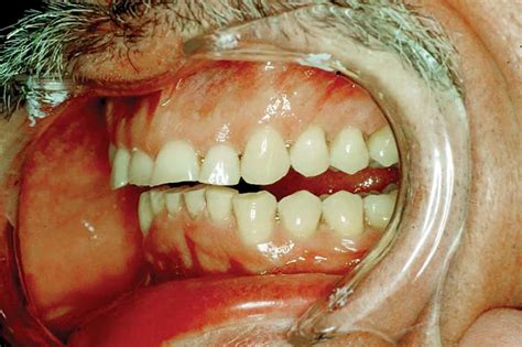 Tooth Surface Loss Bdj At Jake Burdekin Blog Tooth Surface Loss Bdj At Jake Burdekin Blog