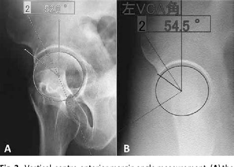 Figure 2 From Usefulness Of Measuring Acetabular Anterior Coverage Using A Tomosynthesis Imaging