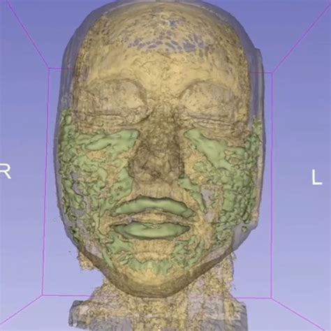 People Are Shocked Mri Of Womans Face After Years Of Dermal Fillers The Hearty Soul People Are Shocked Mri Of Womans Face After Years Of Dermal Fillers The Hearty Soul