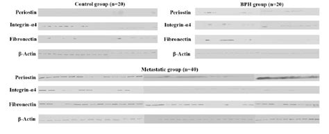 Figure 1 From Do The Expressions Of Epithelial Mesenchymal Transition Proteins Periostin