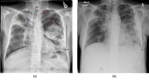 A Two Months After Initial Tb Diagnosis Cxr On Admission Showing New Download Scientific