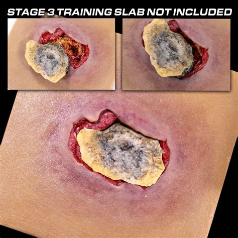 Pressure Ulcer Simulation Insert Necrosis Eschar Cts Up4