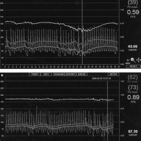 A Fractional Flow Reserve Ffr Pre Stenting Time In Seconds