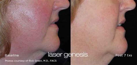 Laser Genesis Benefits Cost Orange County