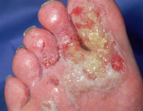 Tinea Pedis Athletes Foot Causes Symptoms Diagnosis And Treatment