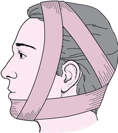 Image Bartons Bandage Msd Manual Consumer Version