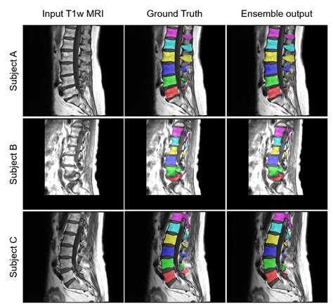 developing custom 3d medical image segmentation solutions using out of the box pipelines in monai