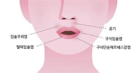 입 주변 뾰루지 위치가 중요한 이유