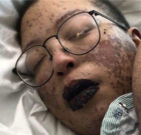 Crusted Lesion On Lips And Desquamating Rash On Cheek Download