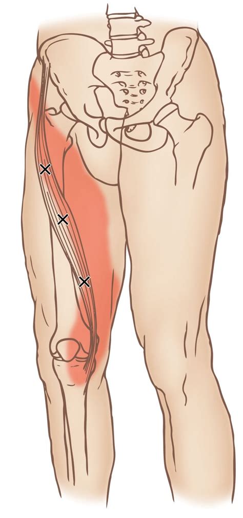Sartorius Trigger Point Learn Muscles