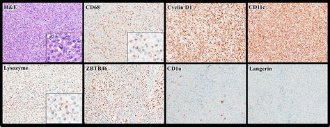 Malignant Histiocytosis Comprises A Phenotypic Spectrum That Parallels