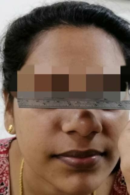 Measurement Of Width Of Face Using Scale Download Scientific Diagram