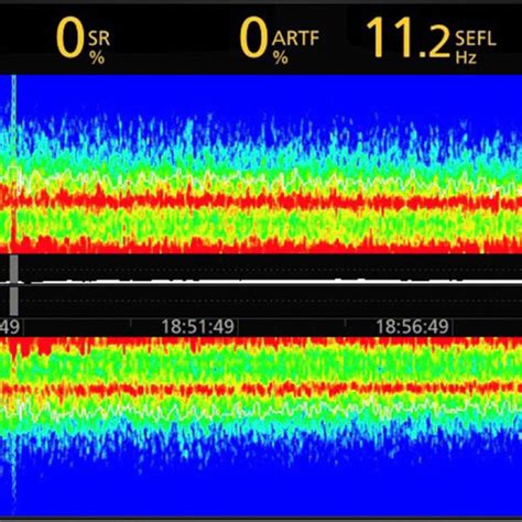 Spectrogram Of Propofol Based Anesthesia With Highest Power In The