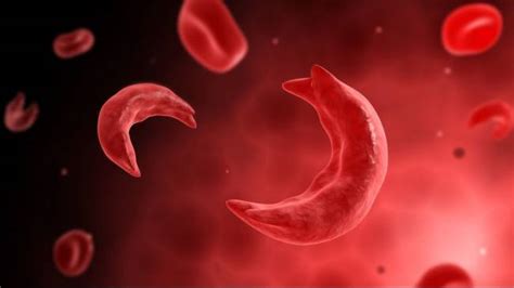 Hari Kesadaran Sel Sabit Sedunia Juni Penyakit Langka Sel Darah Merah Berbentuk Bulan Sabit