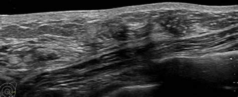 Breast And Axilla 52 Malignant Breast Lesions Case 522 Breast Carcinoma Diagnostic