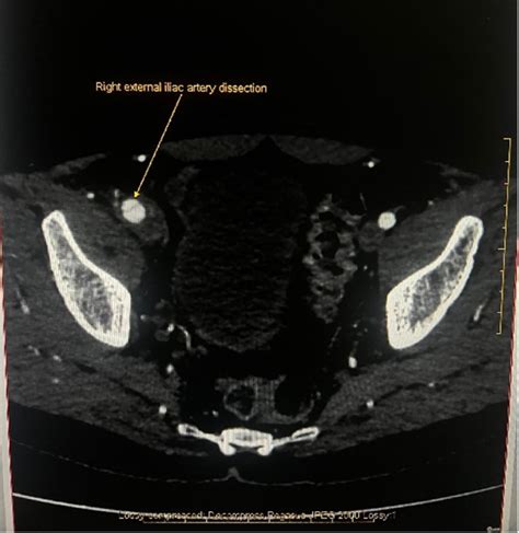 Spontaneous Isolated Iliac Artery Dissection In A Young Male Case